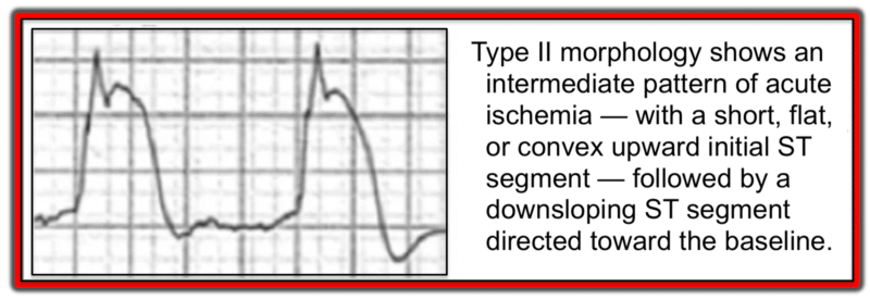 A 35-year old woman with this post-ROSC ECG. What does "shark fin ...