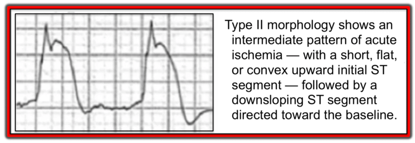A 35-year old woman with this post-ROSC ECG. What does "shark fin ...