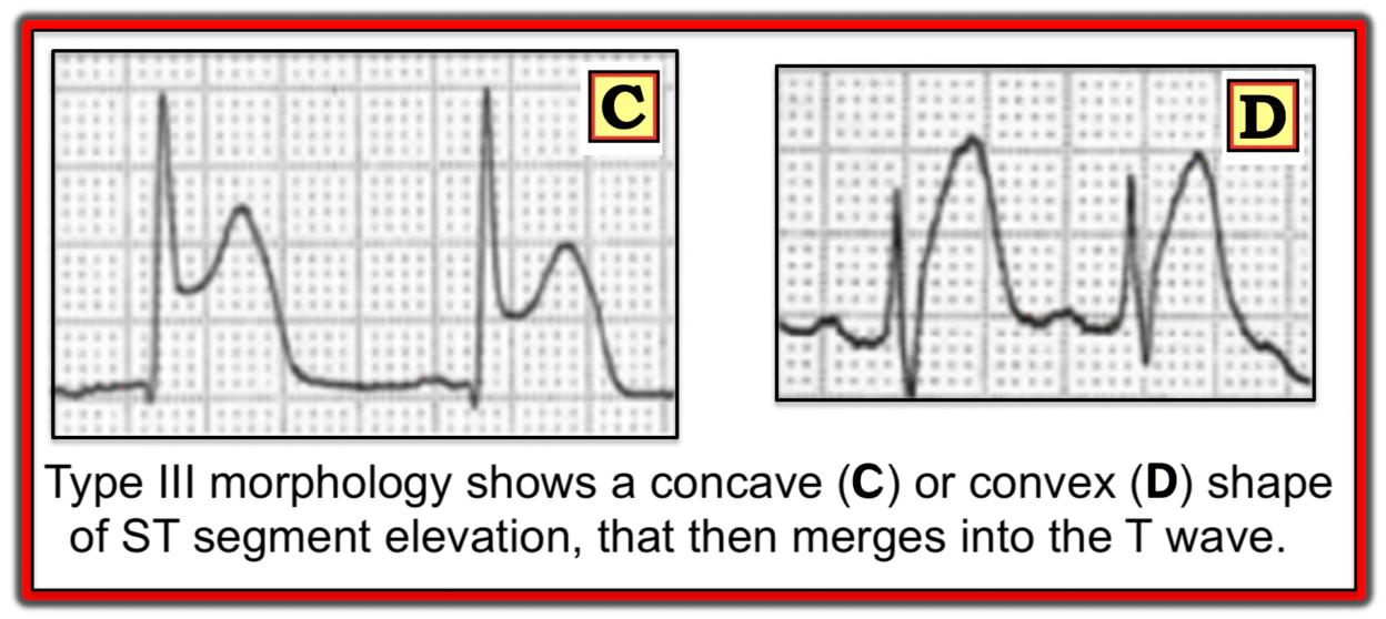 A 35-year old woman with this post-ROSC ECG. What does "shark fin ...