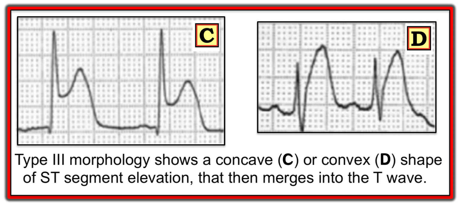 A 35-year old woman with this post-ROSC ECG. What does "shark fin ...