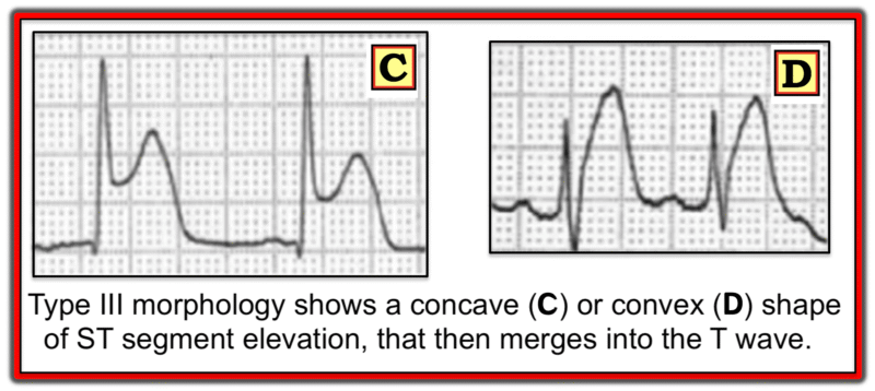 A 35-year old woman with this post-ROSC ECG. What does "shark fin ...