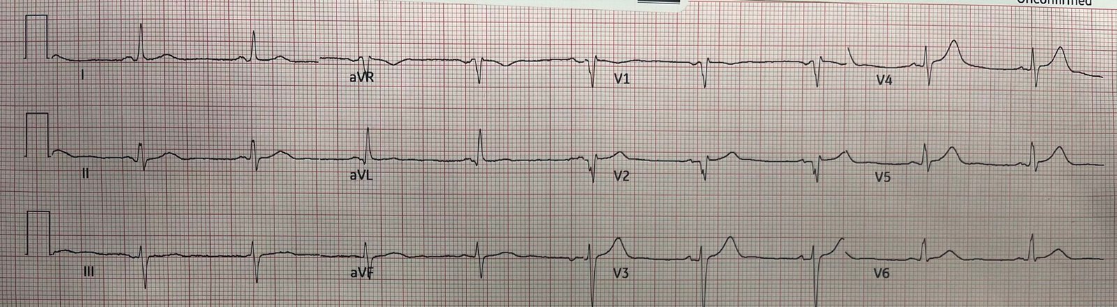 Chest pain, this ECG, and an undetectable troponin after 6 hours of ...