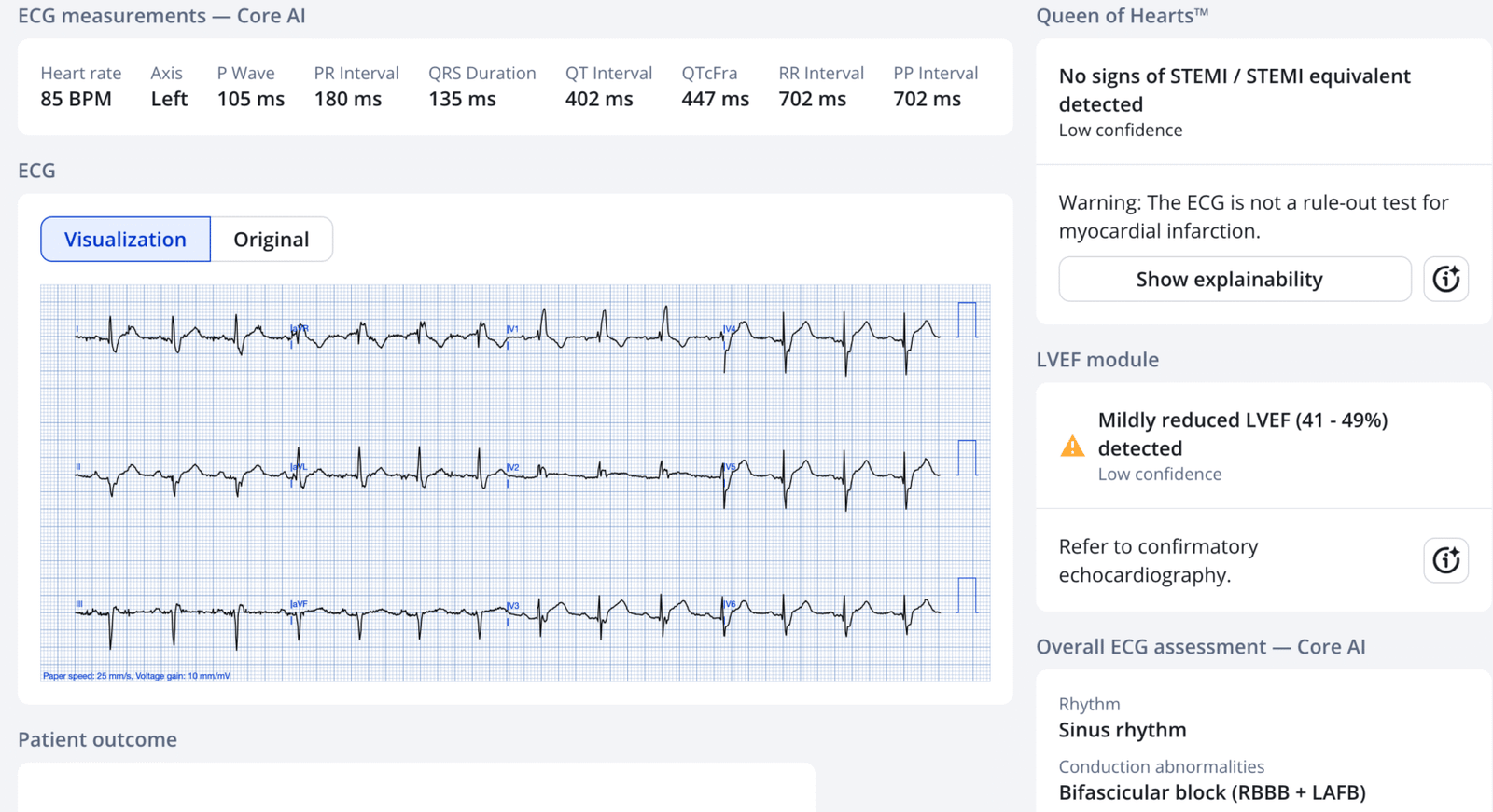 70-something with acute chest pain, Right Bundle Branch block, ST ...