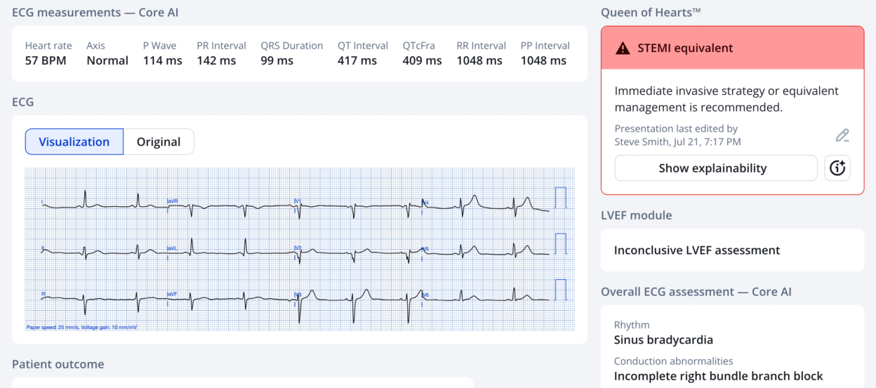 Chest pain, this ECG, and an undetectable troponin after 6 hours of ...
