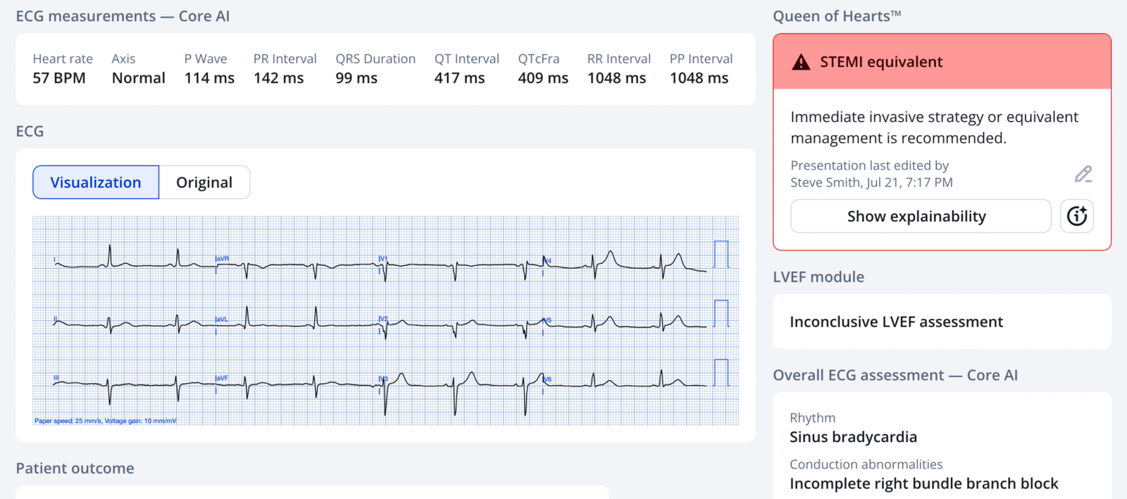 Chest pain, this ECG, and an undetectable troponin after 6 hours of ...