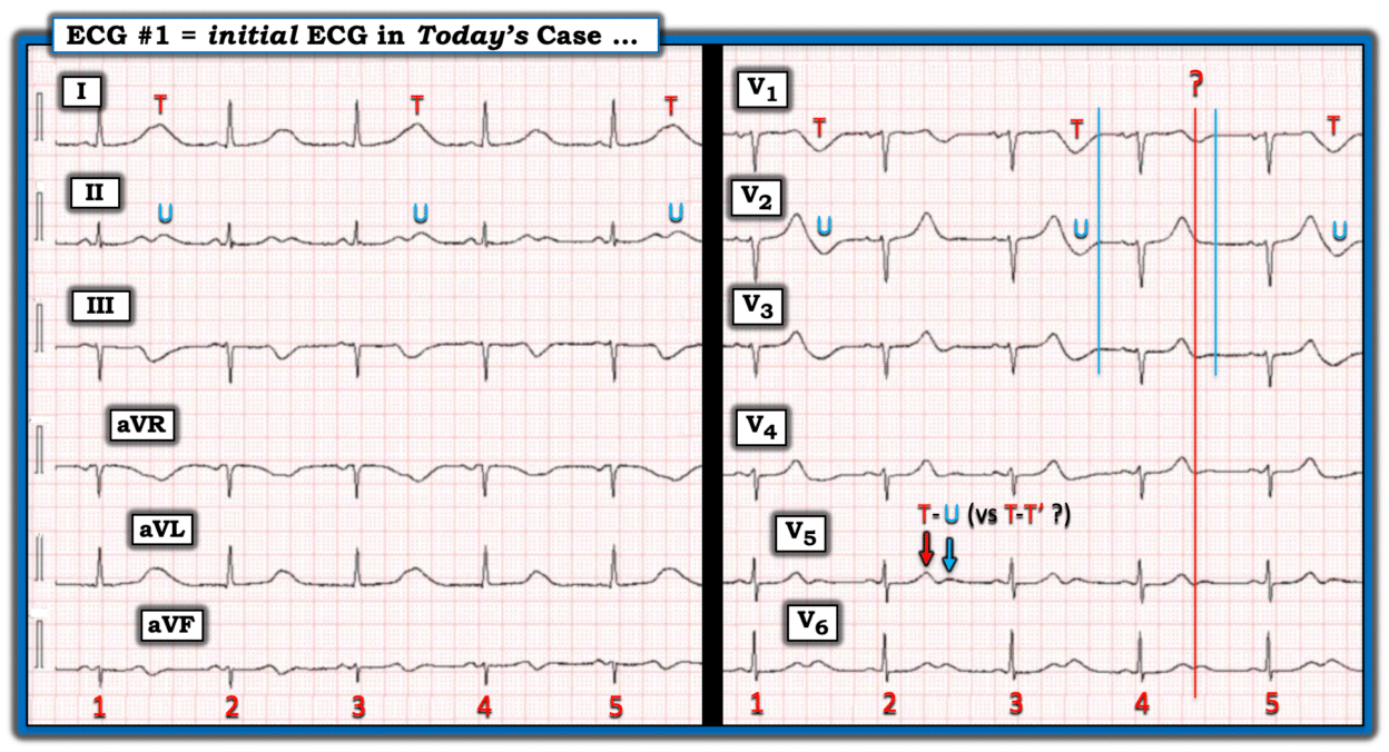Online QTc Calculator for normal and wide QRS (LBBB, RBBB, etc.) - Dr ...