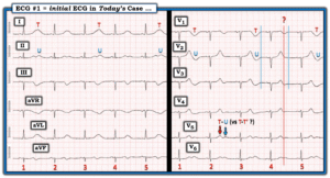 Online QTc Calculator for normal and wide QRS (LBBB, RBBB, etc.) - Dr ...