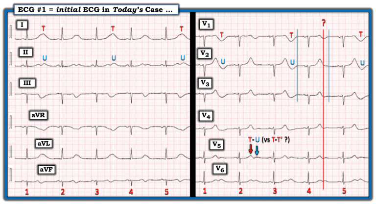 Online QTc Calculator for normal and wide QRS (LBBB, RBBB, etc.) - Dr ...