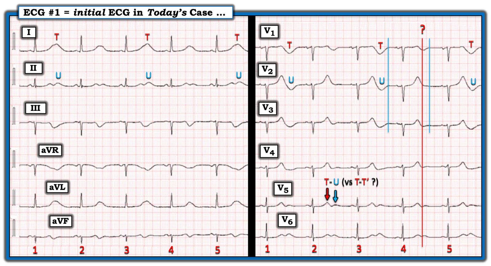 Online QTc Calculator for normal and wide QRS (LBBB, RBBB, etc.) - Dr ...