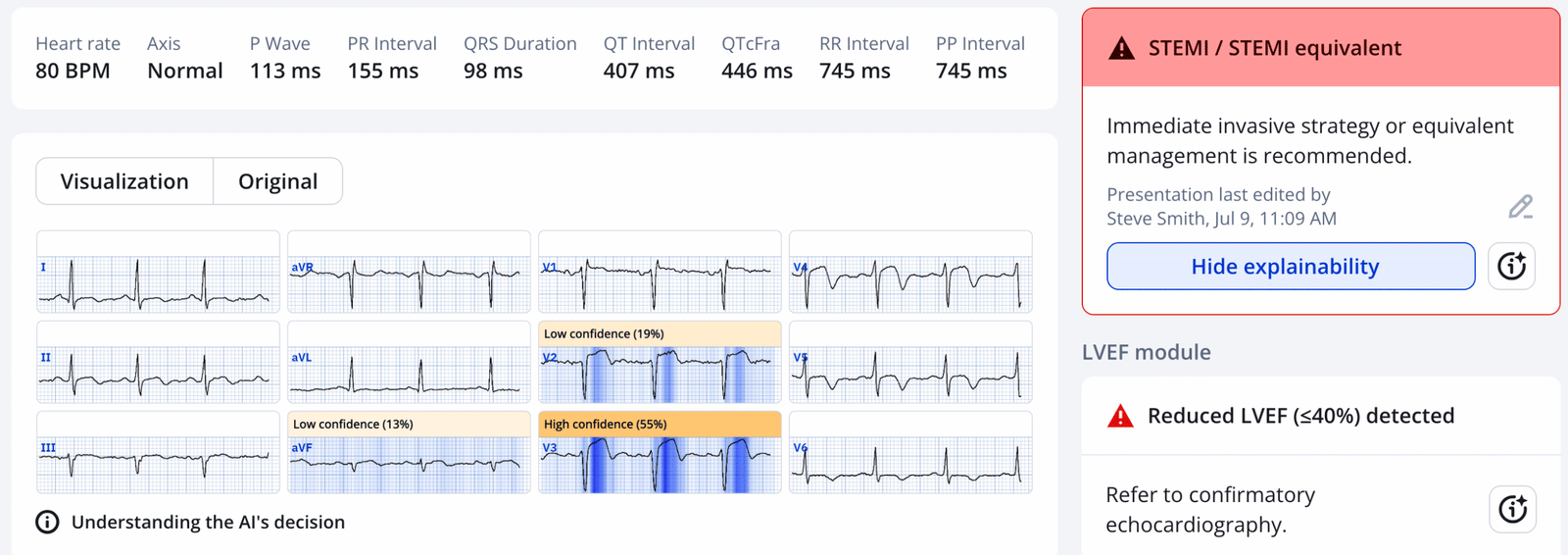 Back to basics: ECGs are dynamic, get serial ECGs and learn the OMI ...