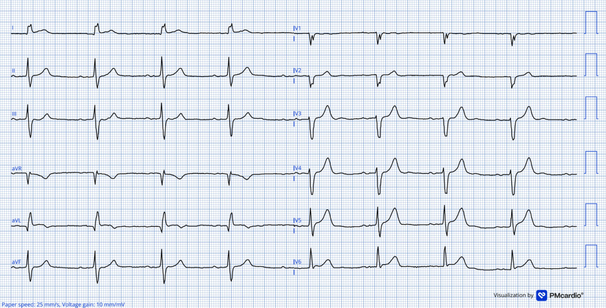 87-year-old with chest pain - Dr. Smith’s ECG Blog