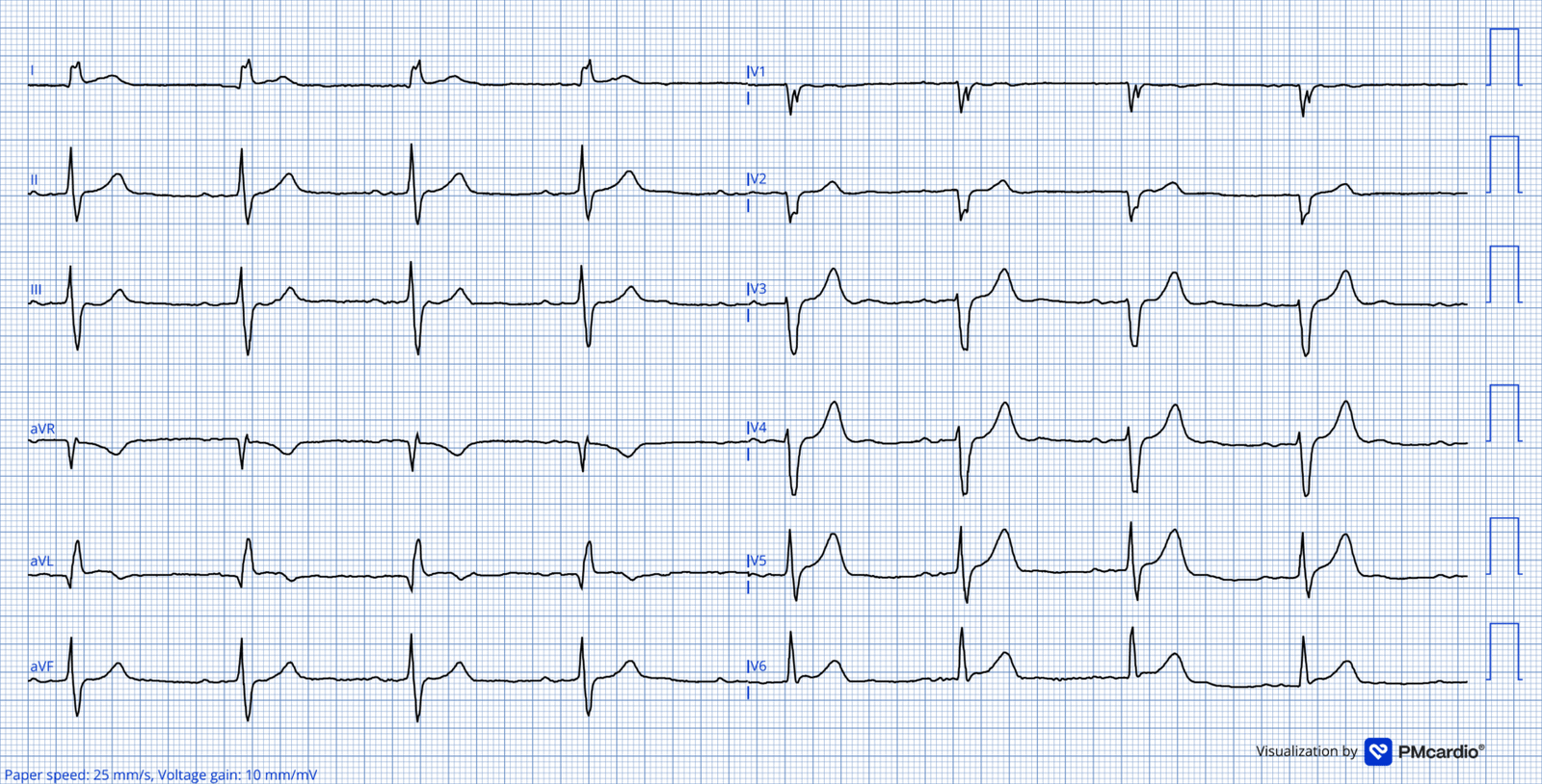 87-year-old with chest pain - Dr. Smith’s ECG Blog