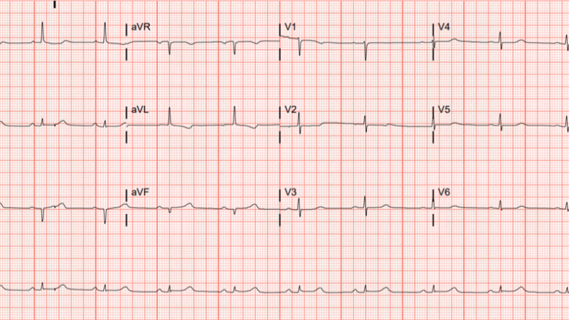 Back to basics: ECGs are dynamic, get serial ECGs and learn the OMI ...