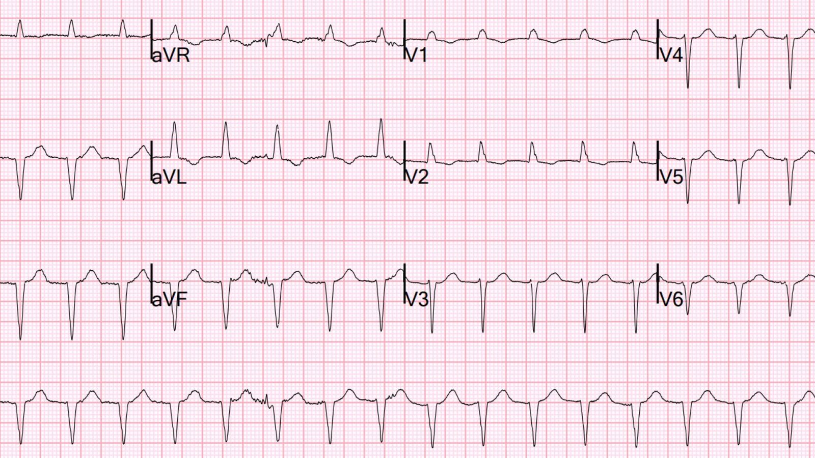 Steve Smith, Author at Dr. Smith’s ECG Blog