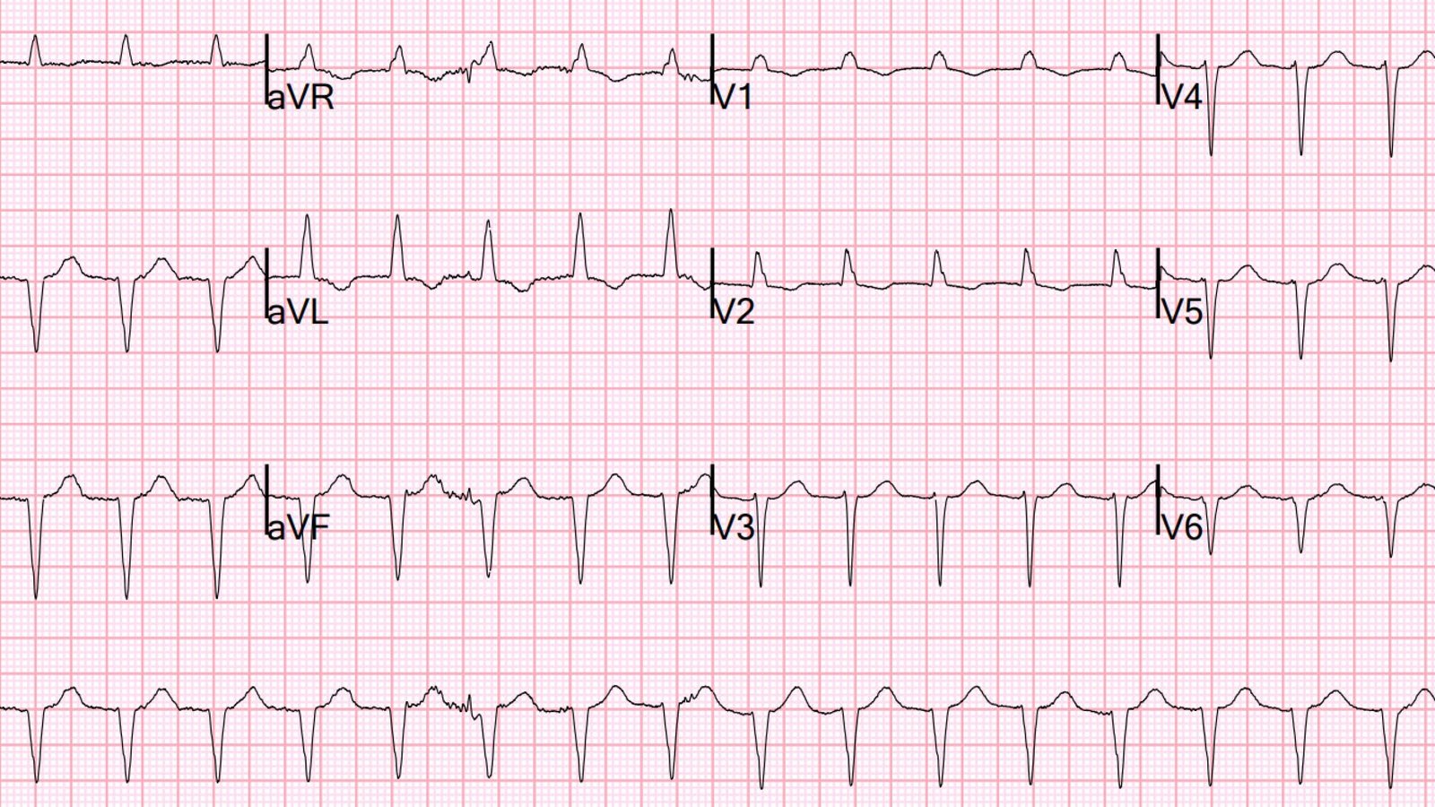 Steve Smith, Author at Dr. Smith’s ECG Blog