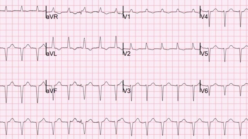 Even OMI that are STEMI are missed, and called "Not a STEMI" - Dr ...