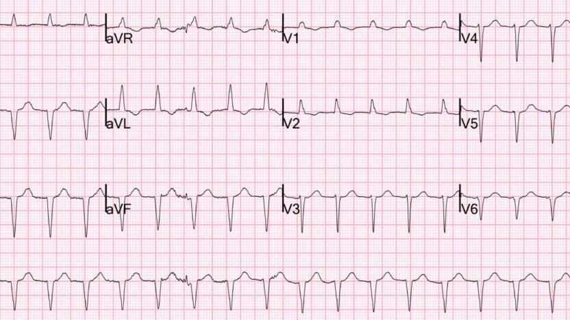 Steve Smith, Author at Dr. Smith’s ECG Blog