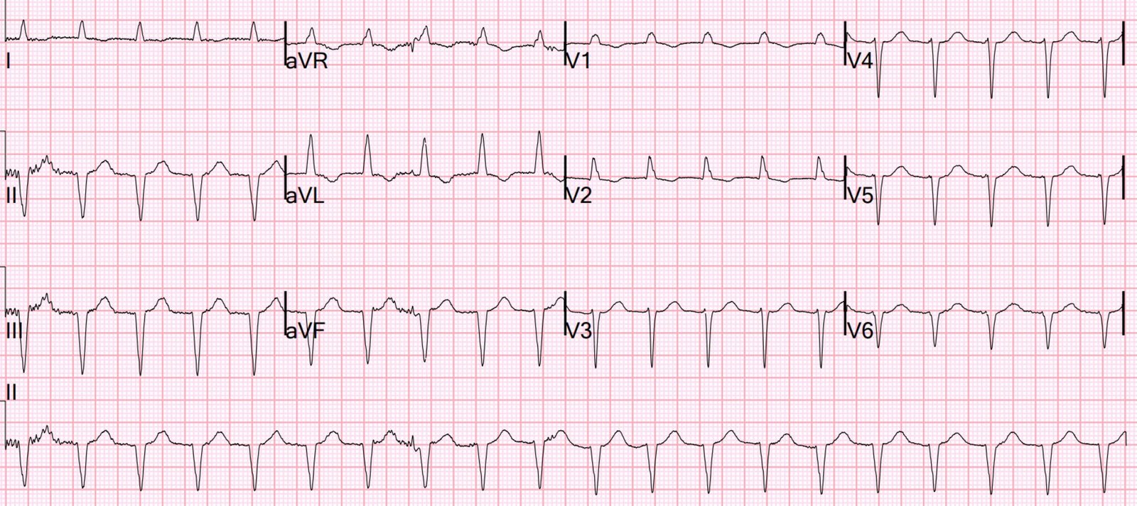 Chest pain and a fast rhythm - Dr. Smith’s ECG Blog
