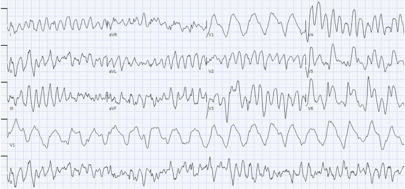 75 year old with acute chest pain: 6 bad reasons not to cath. - Dr ...