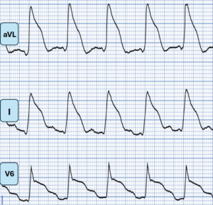 A 35-year old woman with this post-ROSC ECG. What does "shark fin ...