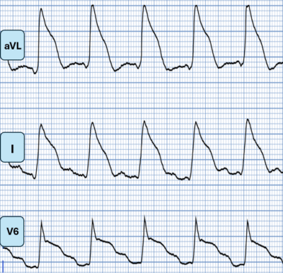 A 35-year old woman with this post-ROSC ECG. What does "shark fin ...
