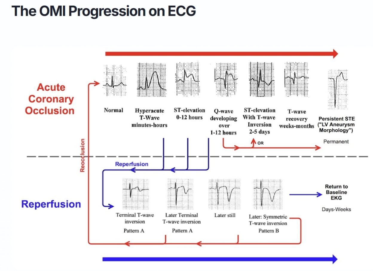 Back to basics: ECGs are dynamic, get serial ECGs and learn the OMI ...