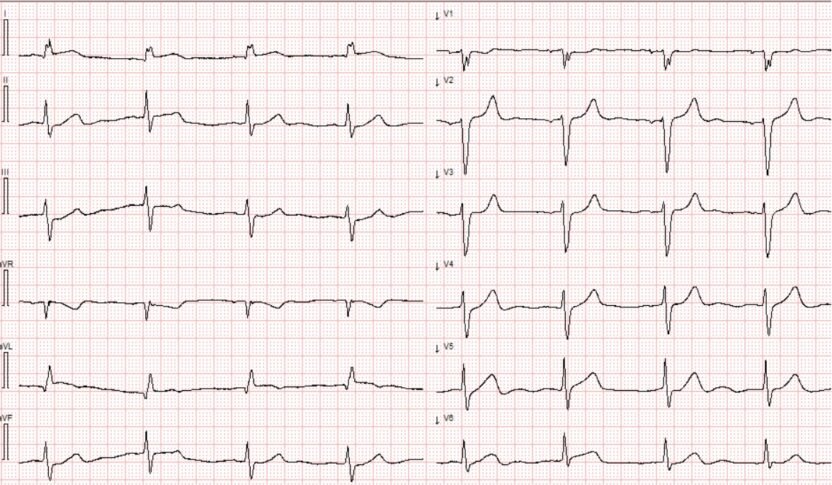 87-year-old with chest pain - Dr. Smith’s ECG Blog