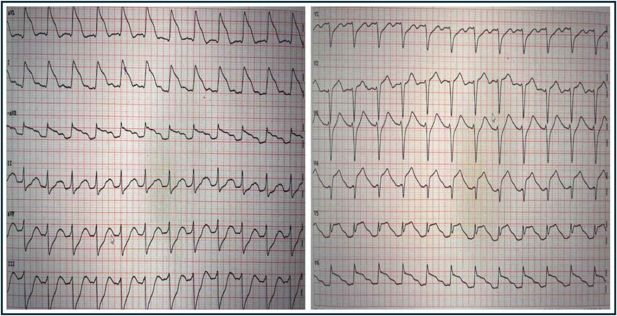 A 35-year old woman with this post-ROSC ECG. What does "shark fin ...