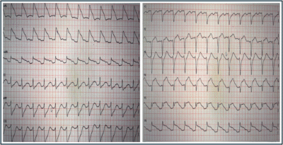 A 35-year old woman with this post-ROSC ECG. What does "shark fin ...