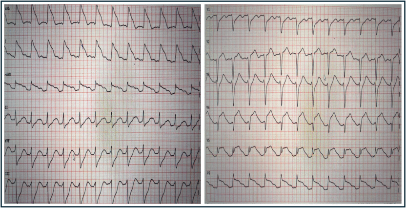 A 35-year old woman with this post-ROSC ECG. What does "shark fin ...
