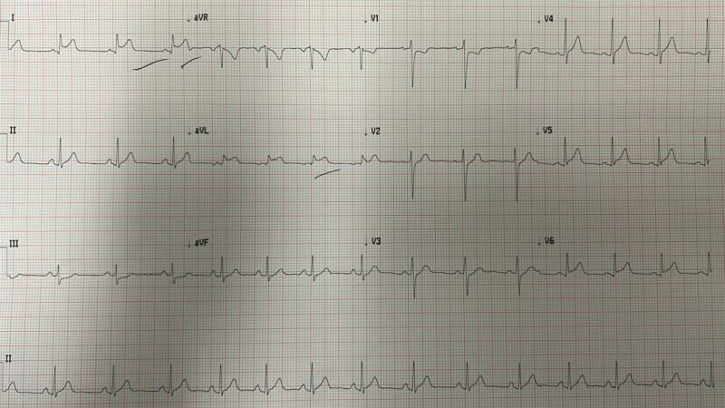 A man in his 60s with acute chest pain. Is this precordial swirl? - Dr ...