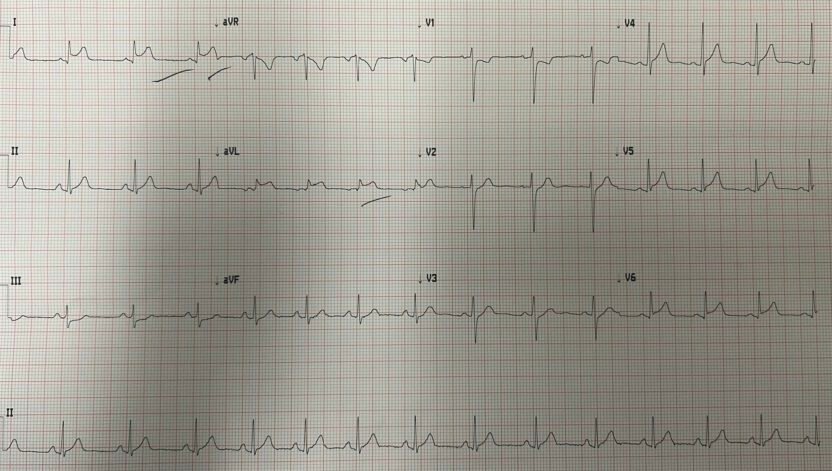 A 35-year old woman with this post-ROSC ECG. What does "shark fin ...