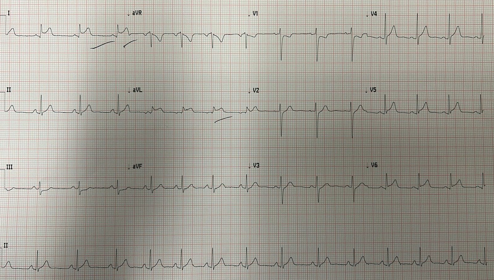 A 15 year old with acute chest pain - Dr. Smith’s ECG Blog