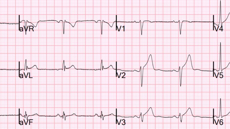 Steve Smith, Author at Dr. Smith’s ECG Blog