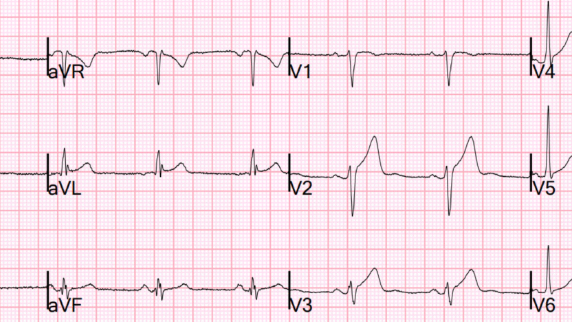 Steve Smith, Author at Dr. Smith’s ECG Blog