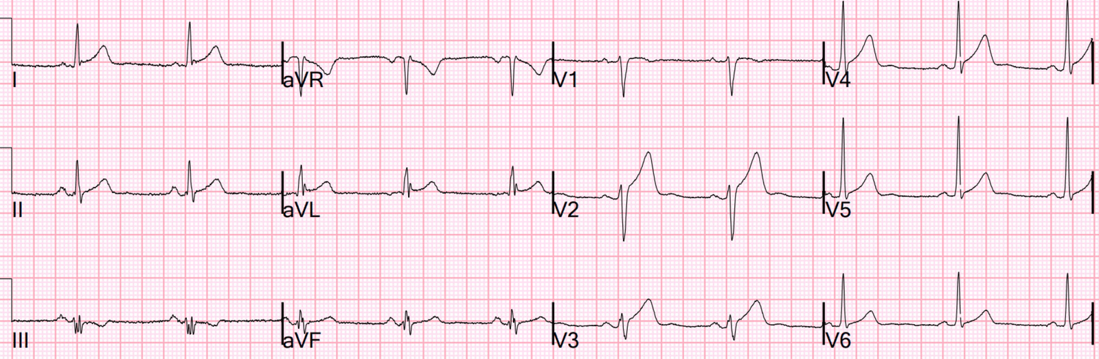 A 40-something male with cough, dyspnea, and chest tightness. - Dr ...