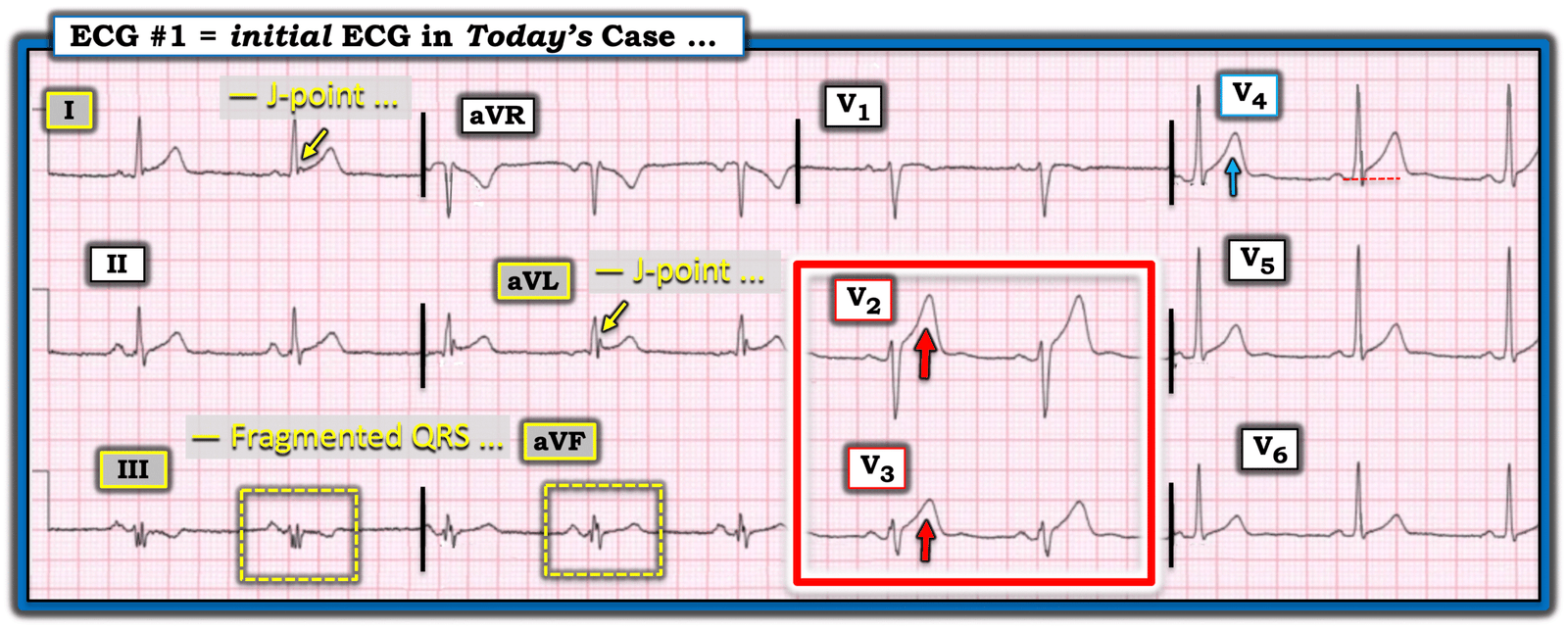 A 40-something male with cough, dyspnea, and chest tightness. - Dr ...