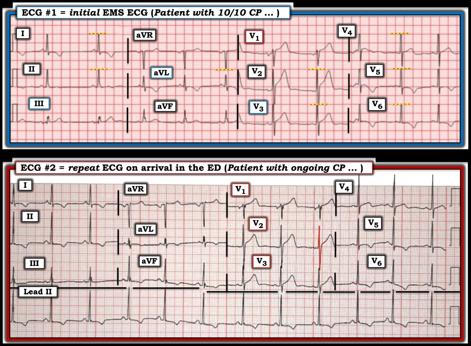 A man in his 60s with acute chest pain. Is this precordial swirl? - Dr ...