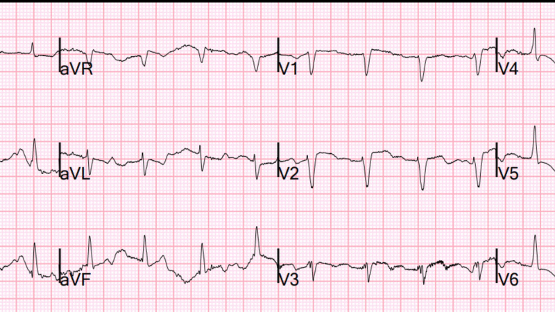 Steve Smith, Author at Dr. Smith’s ECG Blog
