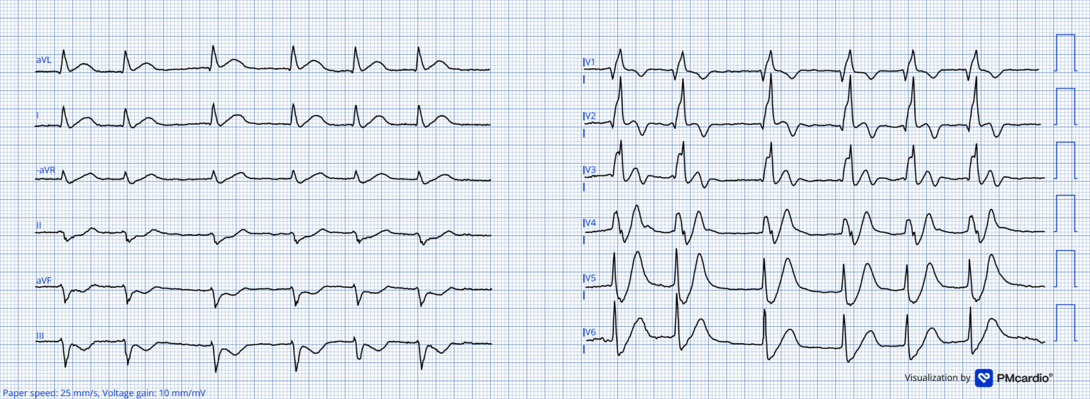 An elderly male with acute chest pain - Dr. Smith’s ECG Blog