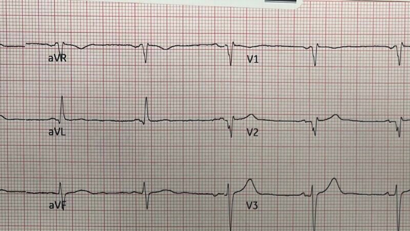 Steve Smith, Author at Dr. Smith’s ECG Blog