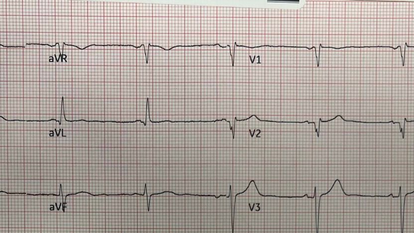 Steve Smith, Author at Dr. Smith’s ECG Blog