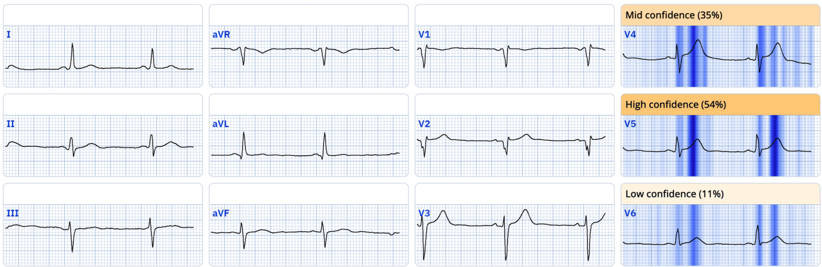 Chest pain, this ECG, and an undetectable troponin after 6 hours of ...