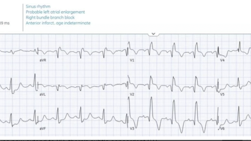 A 35-year old woman with this post-ROSC ECG. What does "shark fin ...