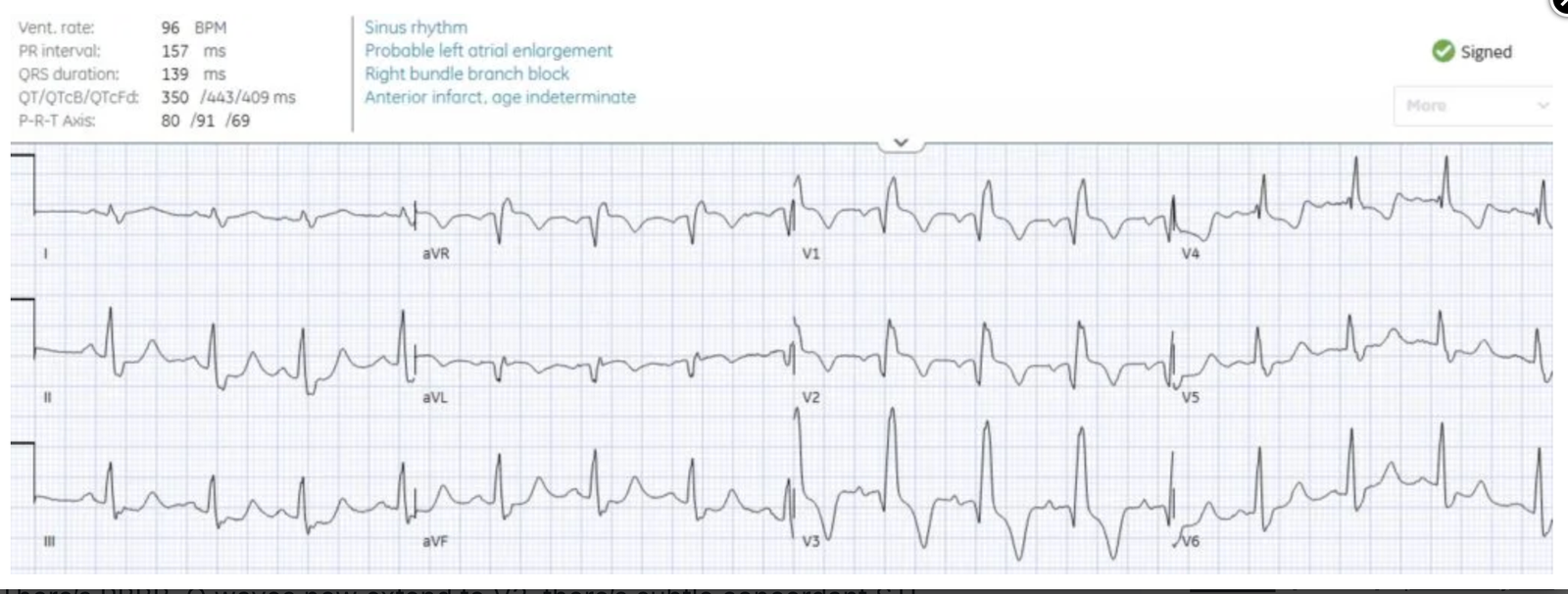 Chest pain with acute RBBB: just another NSTEMI? - Dr. Smith’s ECG Blog