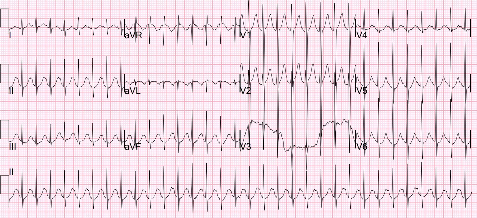 A 30-something agitated male with a regular narrow complex tachycardia ...