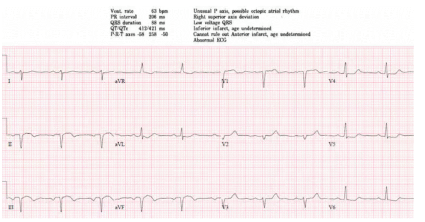 Five Lessons from a Misleading ECG - Dr. Smith’s ECG Blog
