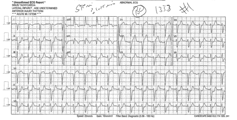 Five Lessons from a Misleading ECG - Dr. Smith’s ECG Blog