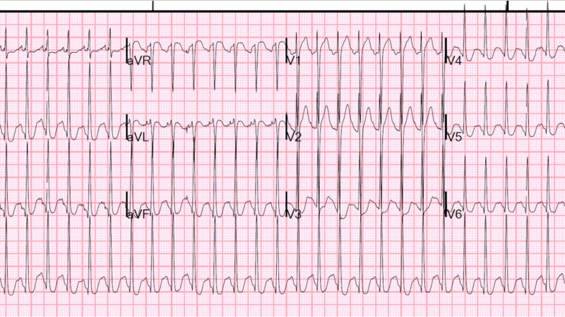 Steve Smith, Author at Dr. Smith’s ECG Blog