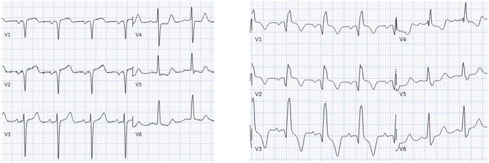Chest pain with acute RBBB: just another NSTEMI? - Dr. Smith’s ECG Blog
